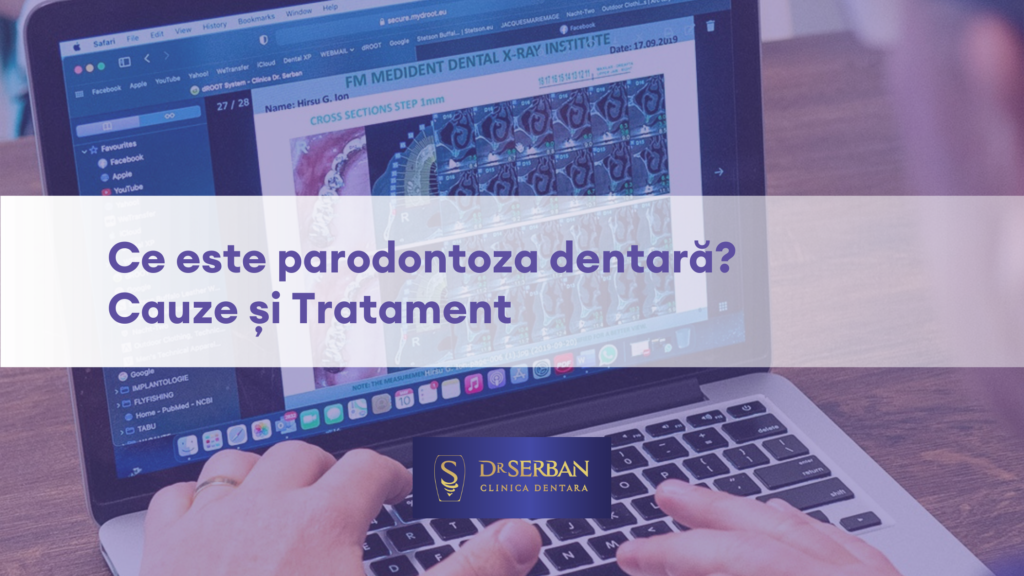 Ce Este Parodontoza Dentară? Cauze și Tratament | Clinica Stomatologică ...